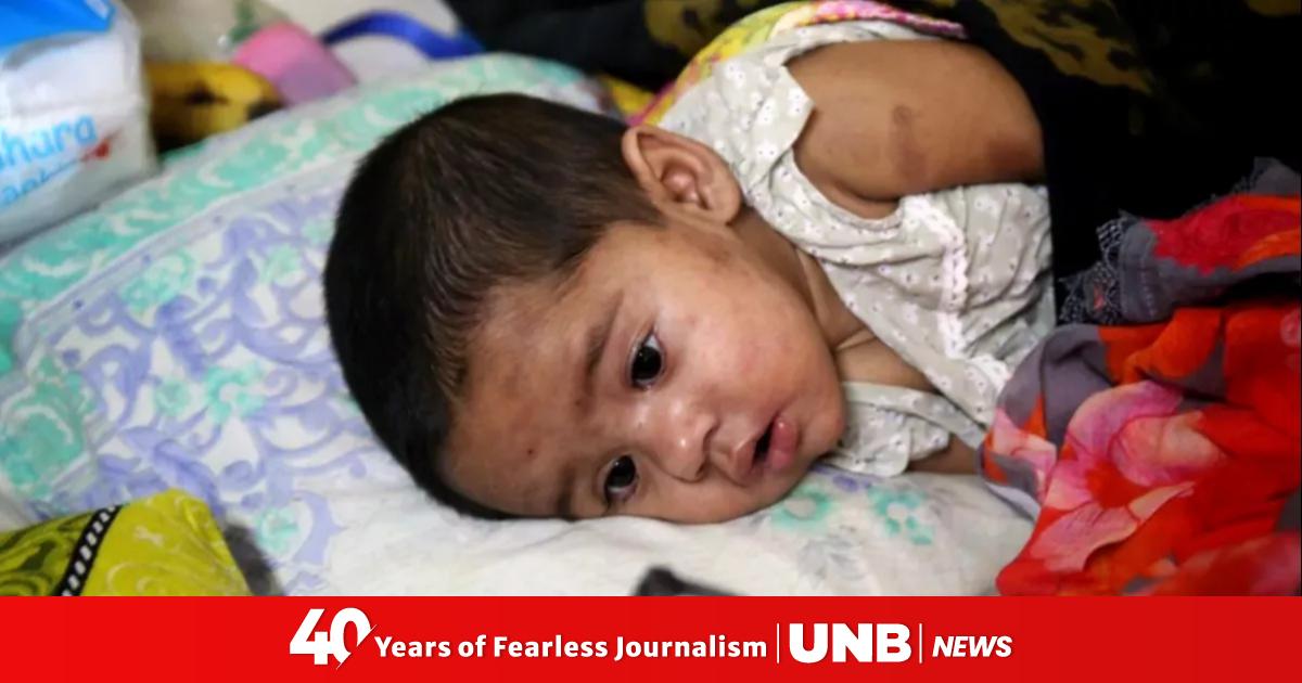 Bangladesh records 3 more suspected measles deaths; fatalities reach 689
